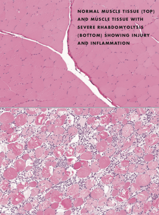 Rhabdomyolysis: What You Need to Know About 'Rhabdo'