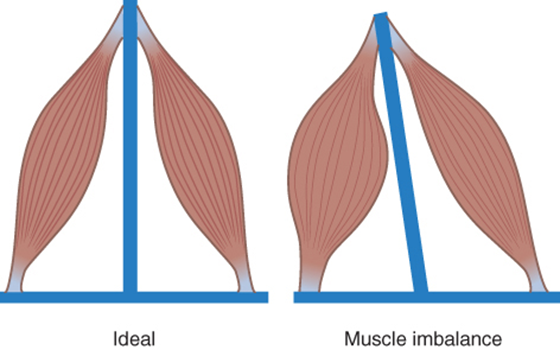 What Is an “Ideal” Static Pelvic Posture? That’s Kind of a Tilted Question