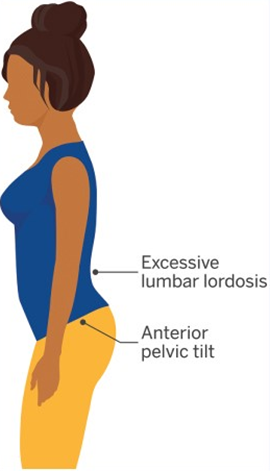 What Is an “Ideal” Static Pelvic Posture? That’s Kind of a Tilted Question